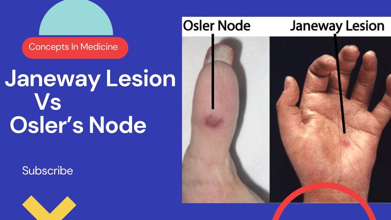 Osler Nodes Endocarditis Cardiovascular Pathology Bacterial