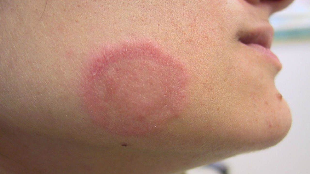 How To Get Rid Of Ringworm Fast At Home Youtube