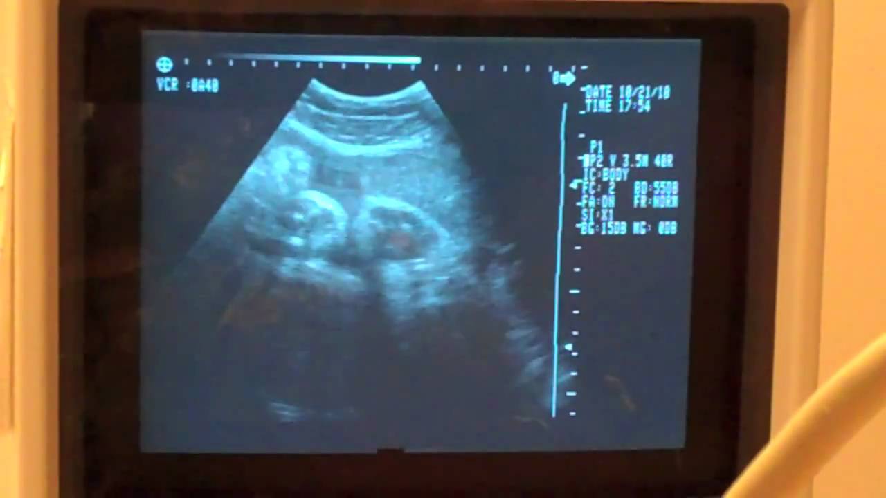 38 Weeks Ultrasound Youtube