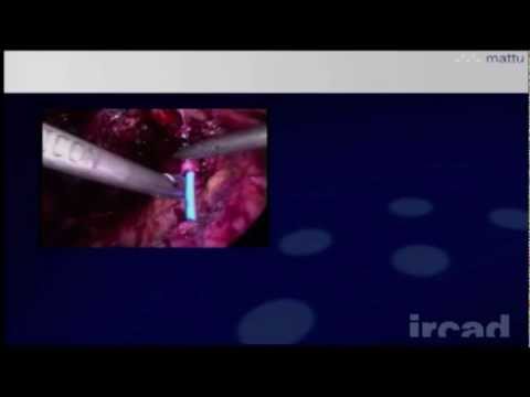 Laparoscopic Suturing Youtube