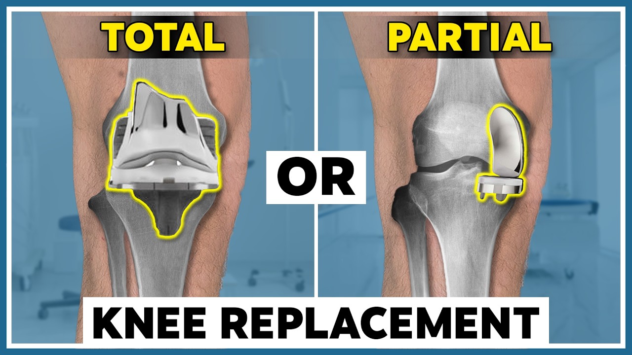 Partial Or Total Knee Replacement How To Choose The Right Knee