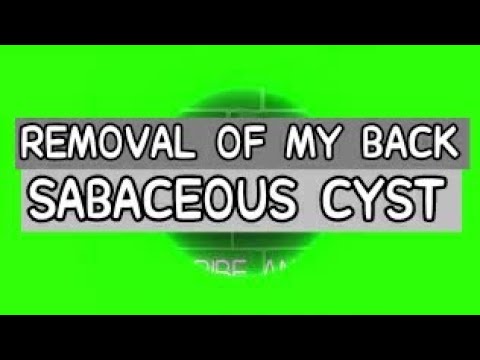 Removal Of My Back Sebaceous Cyst Youtube