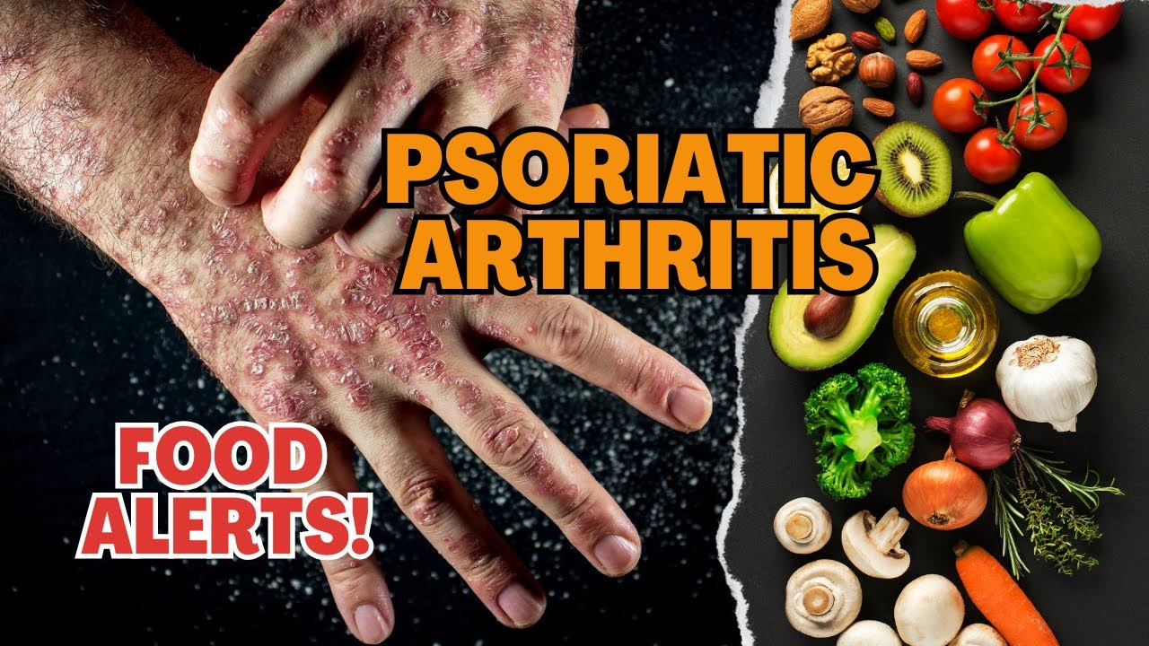Psoriatic Arthritis Diet Foods To Eat And Avoid I Anti Psoriasis