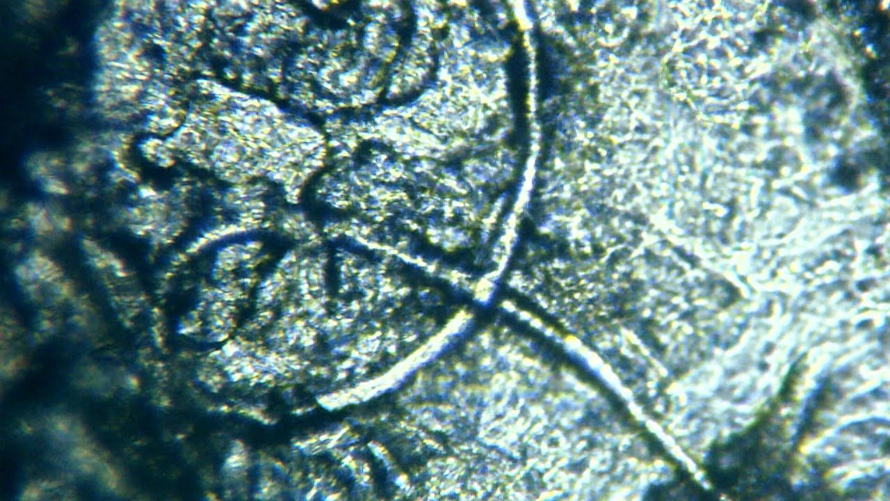 Under A Microscope Acne Pimple Zit Pus Sebum Dead White Blood Cells