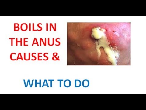 Boils In The Anus Causes Treatment Home Remedies And How To Prevent