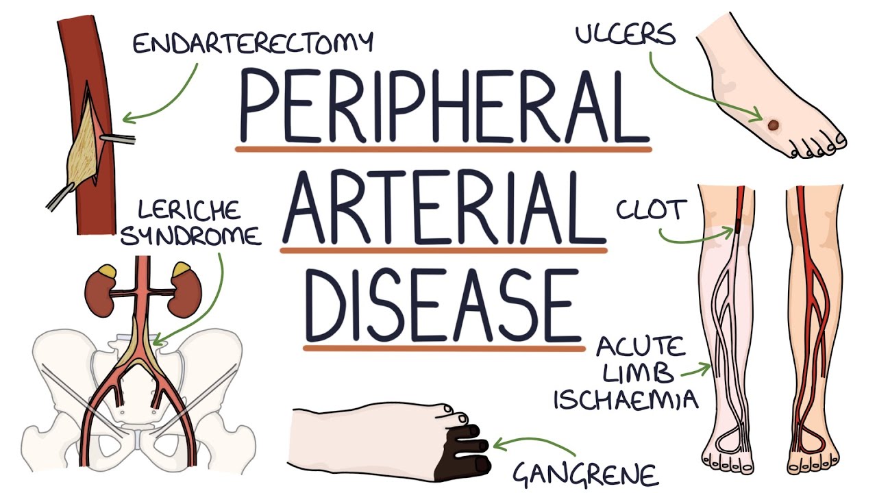 Understanding Peripheral Arterial Disease Diabetes
