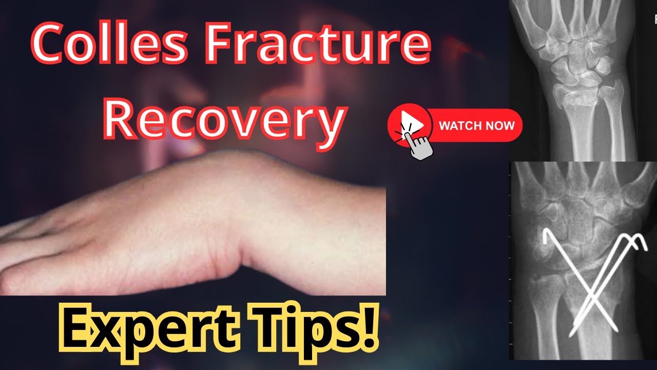 Colles Fracture Symptoms Treatment Options And How To Speed Up