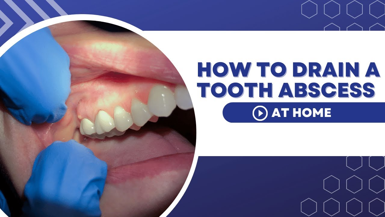 How To Drain A Tooth Abscess At Home Using Home Remedies Youtube