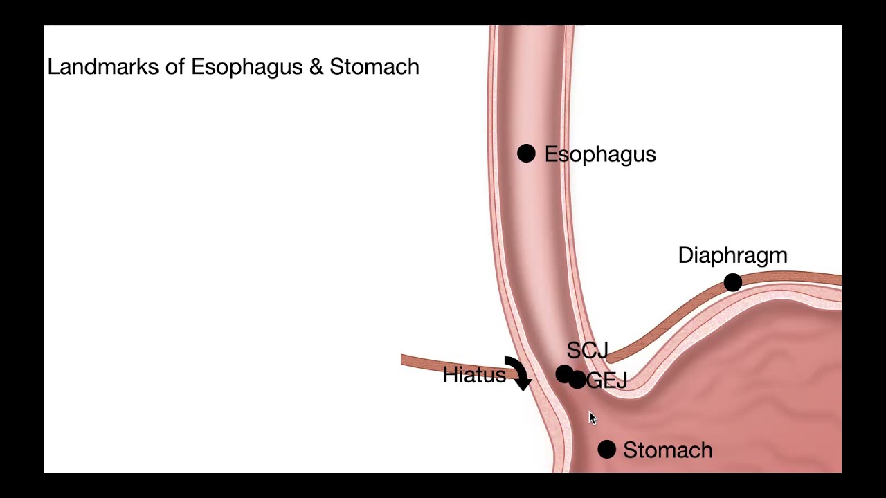 Esophagus Anatomy Distal Proximal Tracheoesophageal Fistula Causes