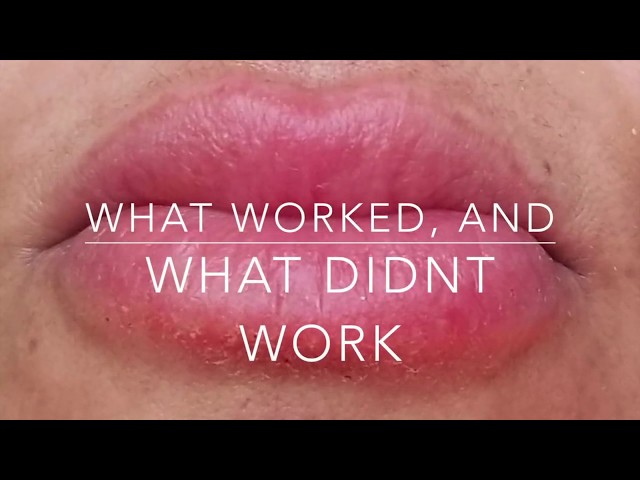 What Allergy Causes Swollen Lips Infoupdate Org