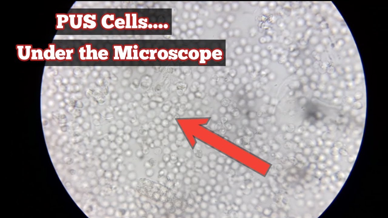 See The Clear Pus Cells Under The Microscope Youtube