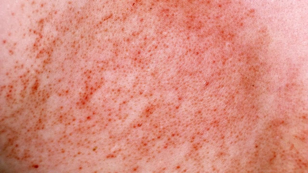 Rash After Exercise At Sofia Goldman Blog