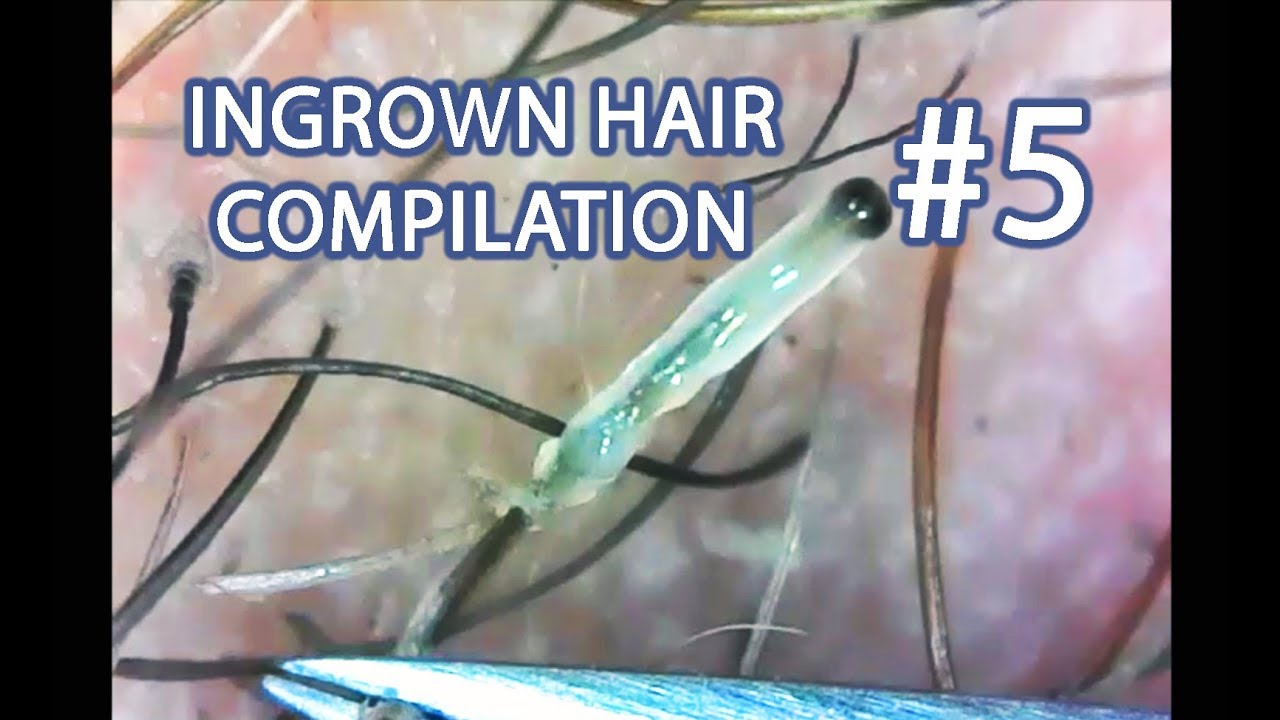Ingrown Hair Compilation 5 Squishies Included Youtube