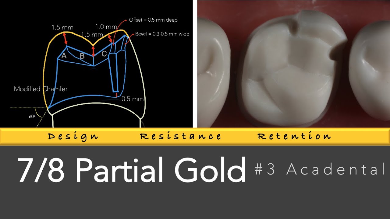Gold Veneers Teeth At Hamish Geake Blog