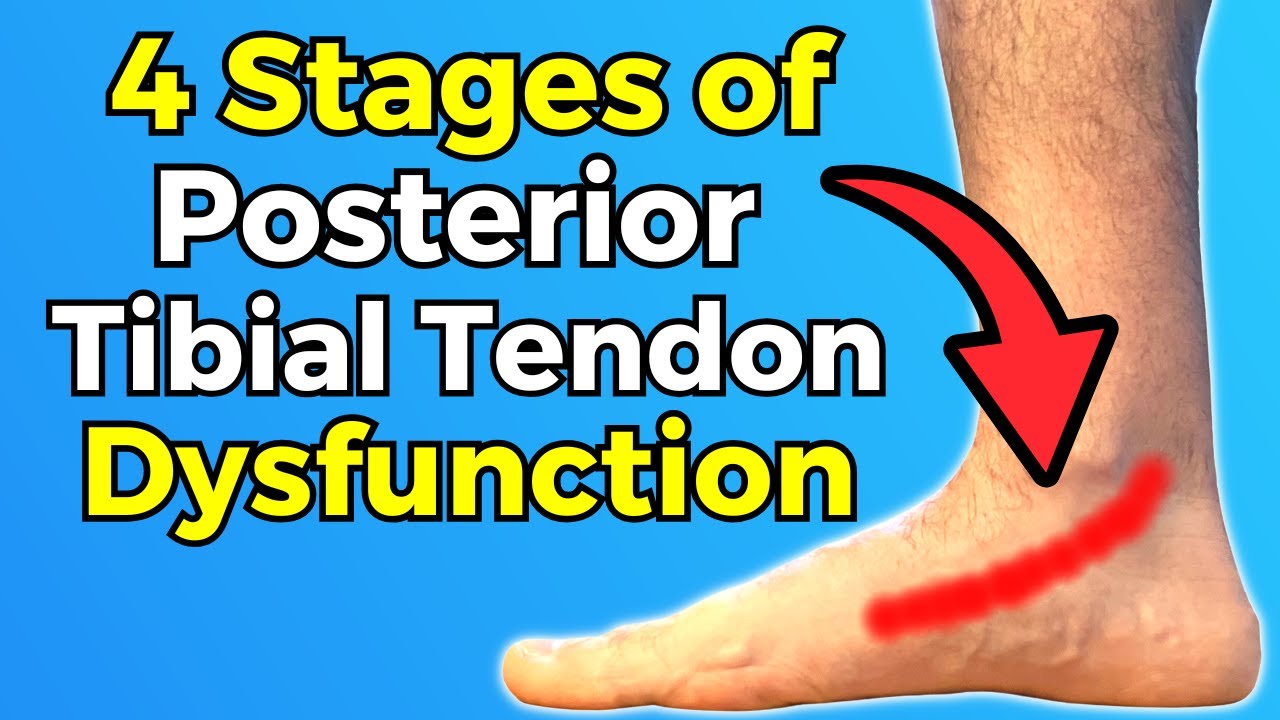 The 4 Stages Of Posterior Tibial Tendon Dysfunction Explained Youtube