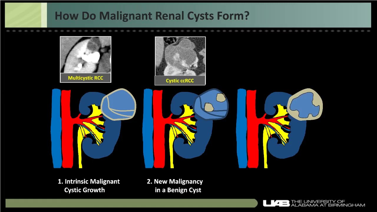 Radiopaedia Bosniak Contrast Enhanced Ultrasound Of Renal Masses