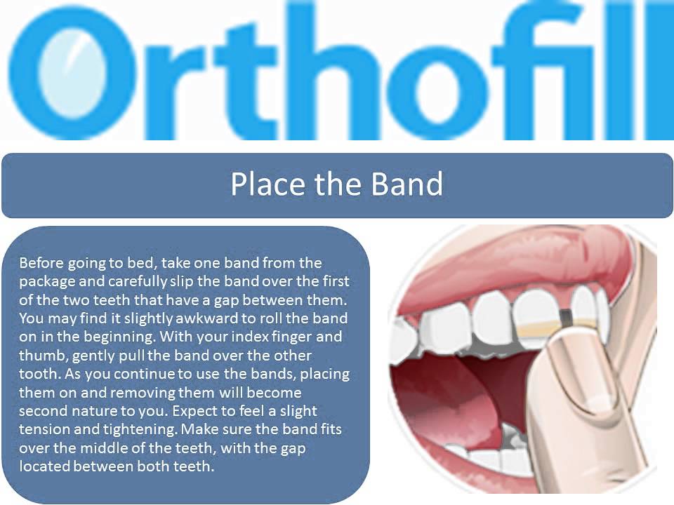 Ortho Fill Gaps Between Teeth Youtube