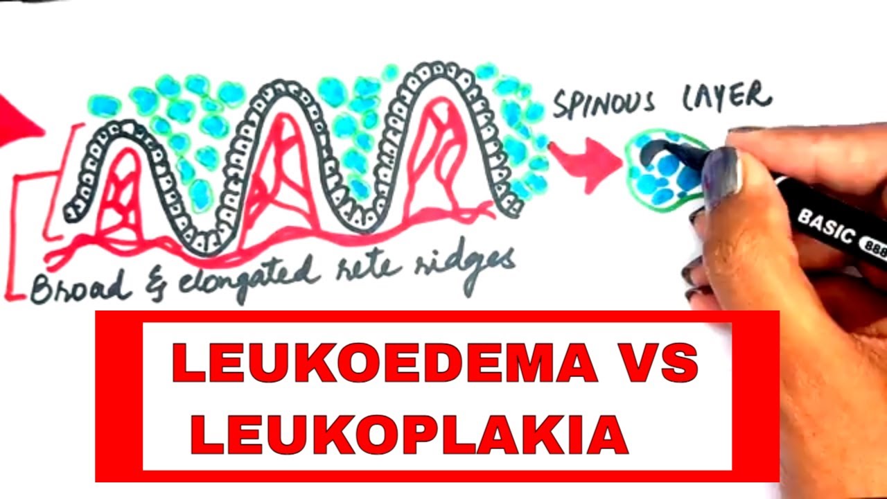 Leukoedema Vs Leukoplakia White Patch In Your Mouth Youtube