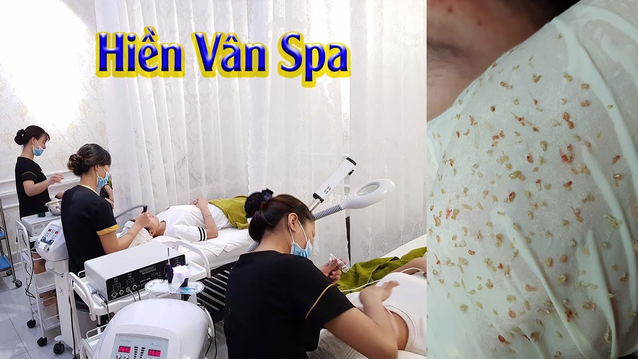 Remove Blackhead Cystic Acne Treatment Effectively In Hien Van Spa 380