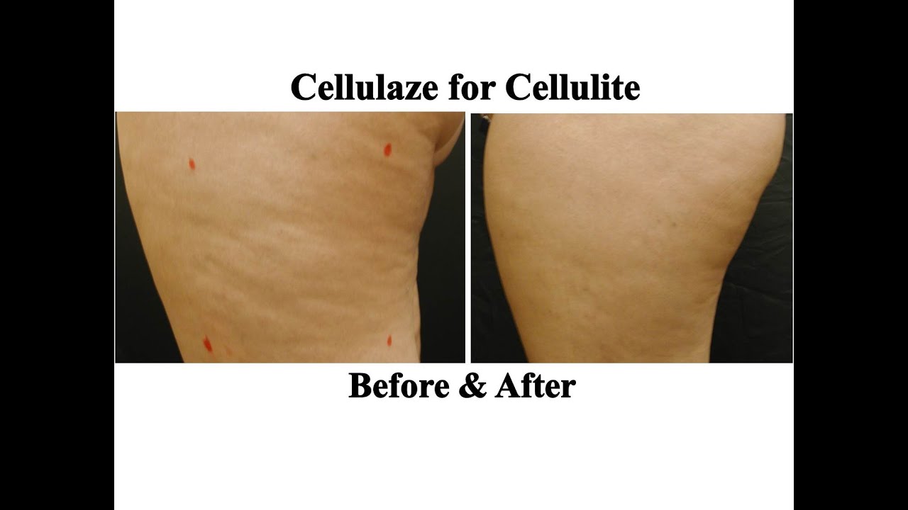 Get Rid Of Cellulite Nyc Cellulaze Q A With Dr Bruce Katz Youtube