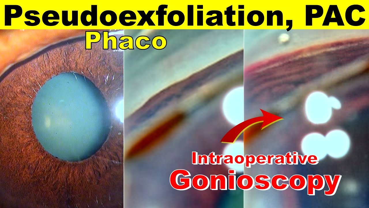 Cataract Surgery Eyes With Pseudoexfoliation Syndrome At Jonathan