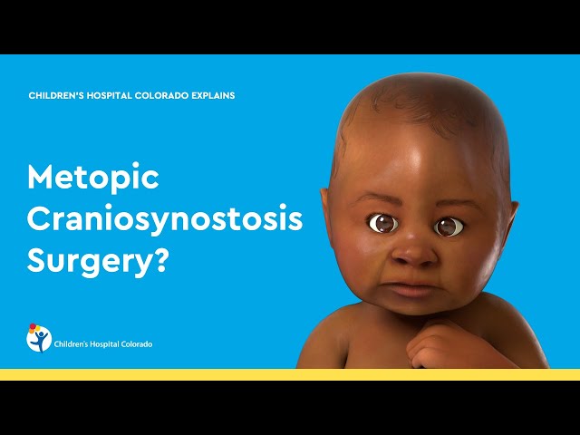 Craniosynostosis