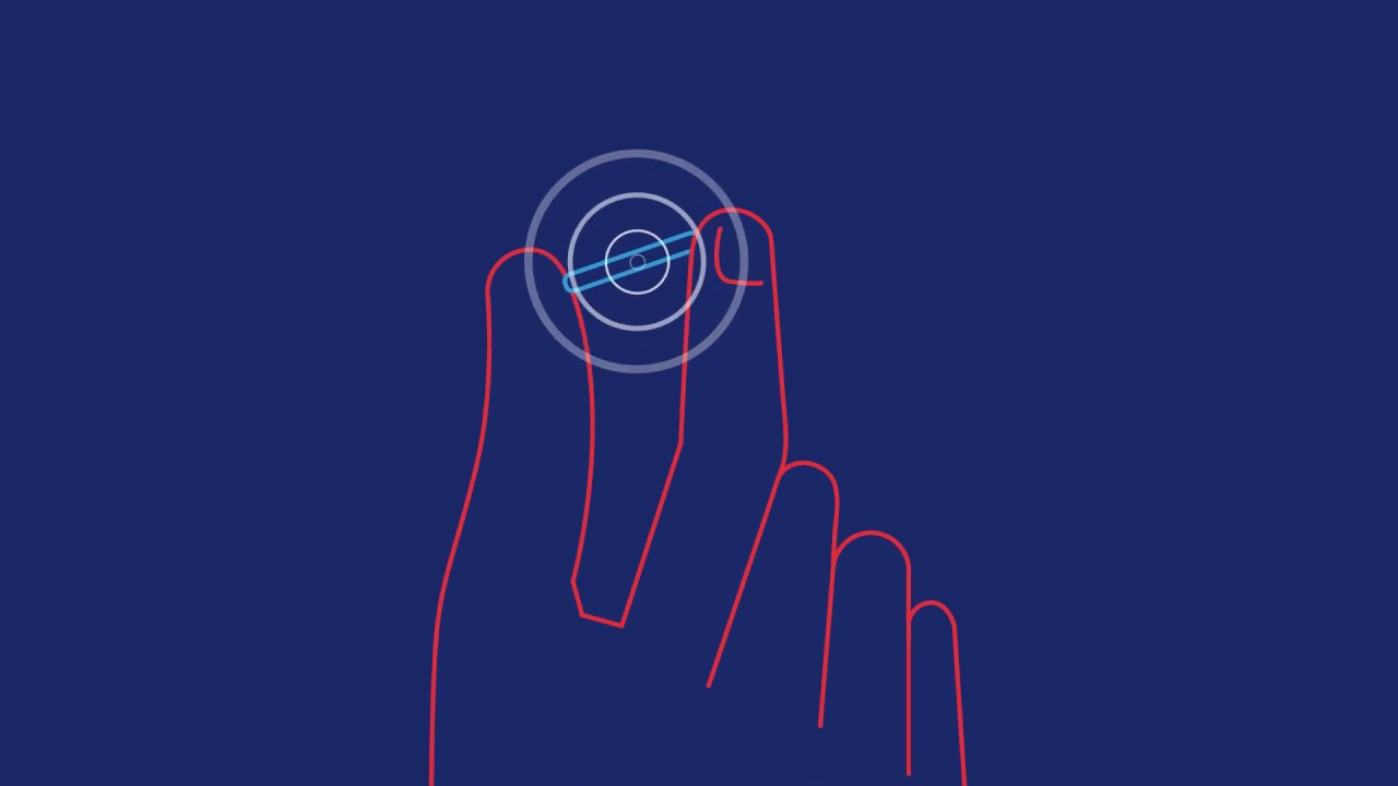 Birth Control Implants Nexplanon Information