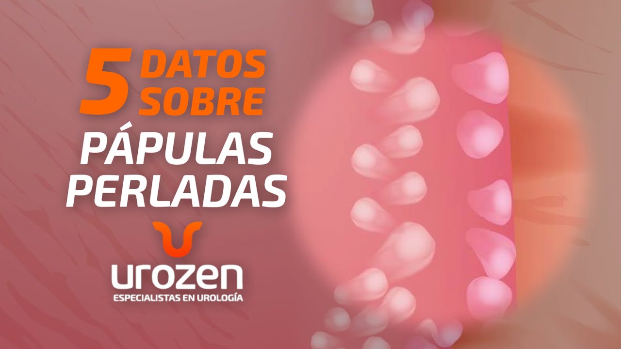 5 Cosas Que Debes Saber Sobre Pápulas Perladas Youtube