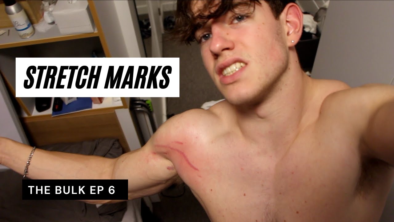 How To Get Rid Of Stretch Marks The Bulk Ep 6 Youtube