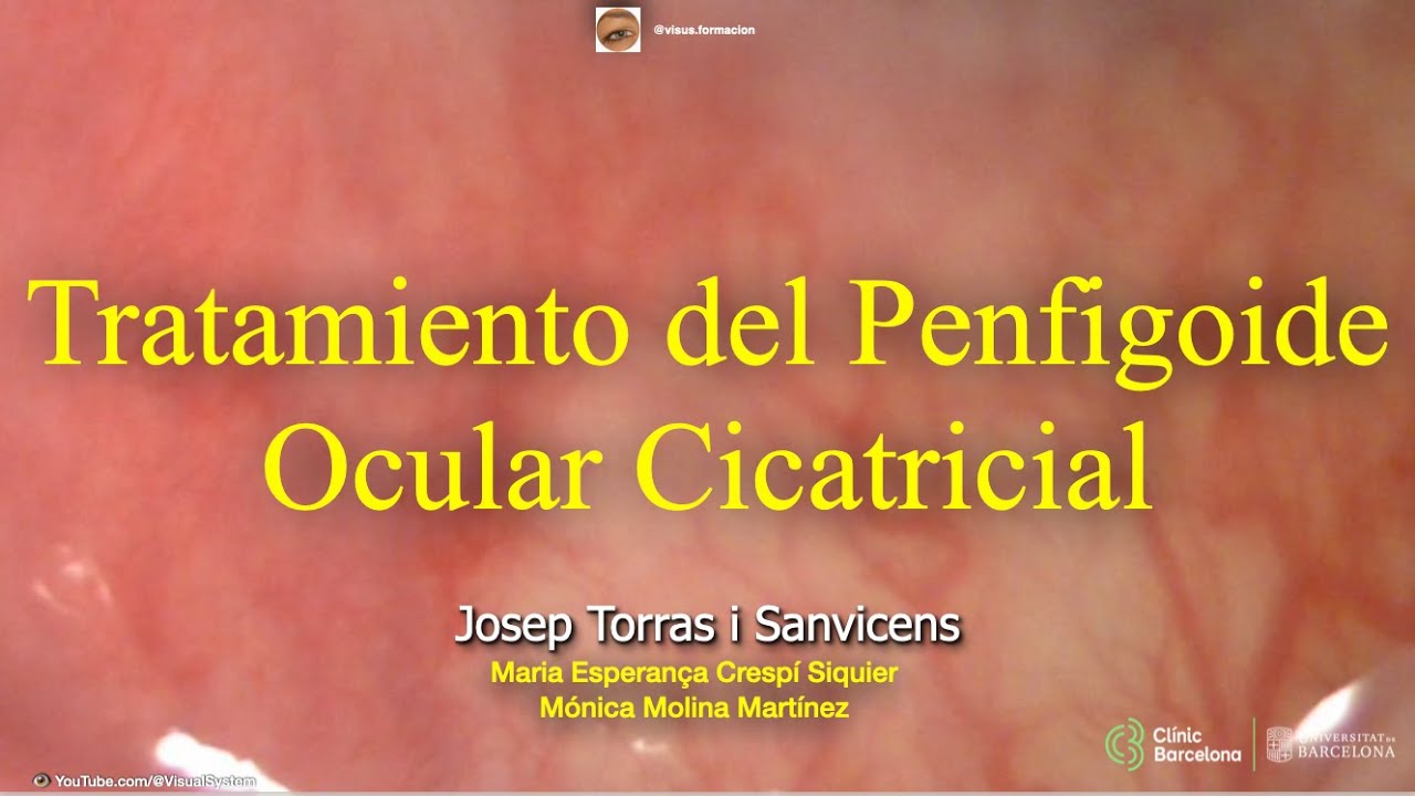 Tratamiento Del Penfigoide Ocular Cicatricial Youtube