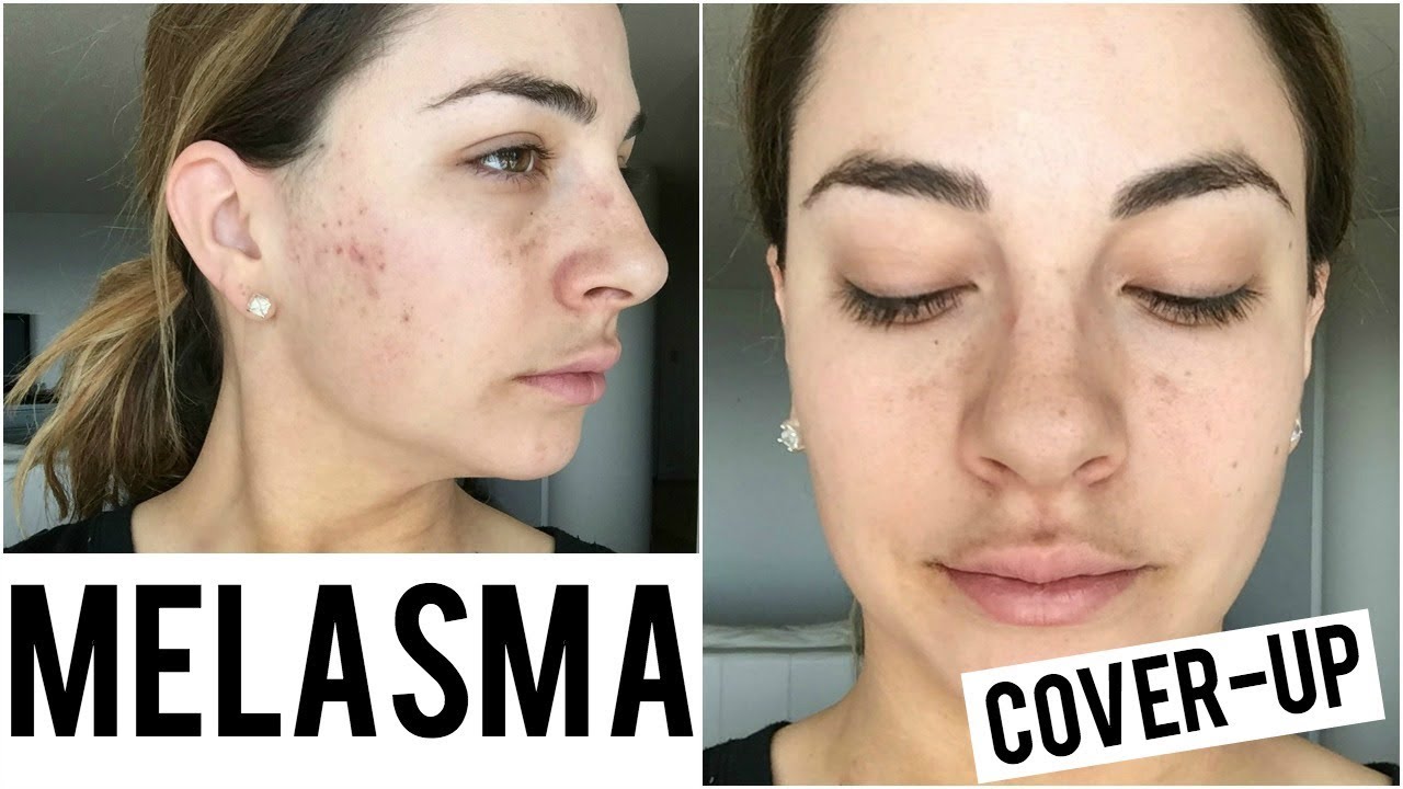 Makeup Tips For Melasma Makeup Vidalondon