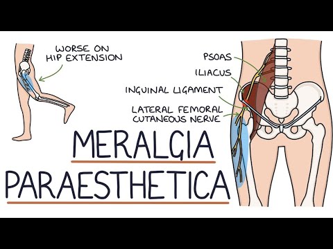 Meralgia Paresthetica Also Known As Lateral Femoral Cutaneous Nerve