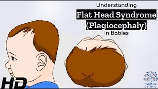 Flat Head Syndrome Explained Causes Symptoms And Solut Doovi