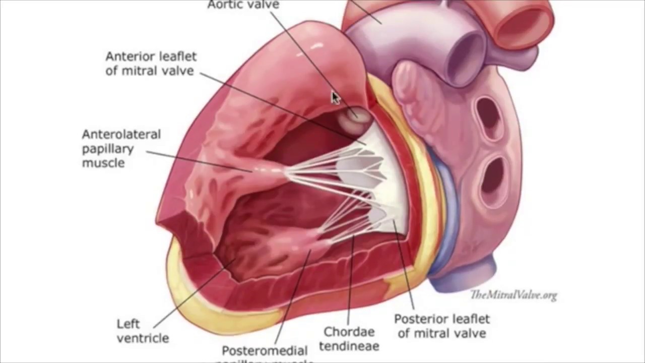 Post Mi Cardiac Rupture Papillary Muscle Youtube