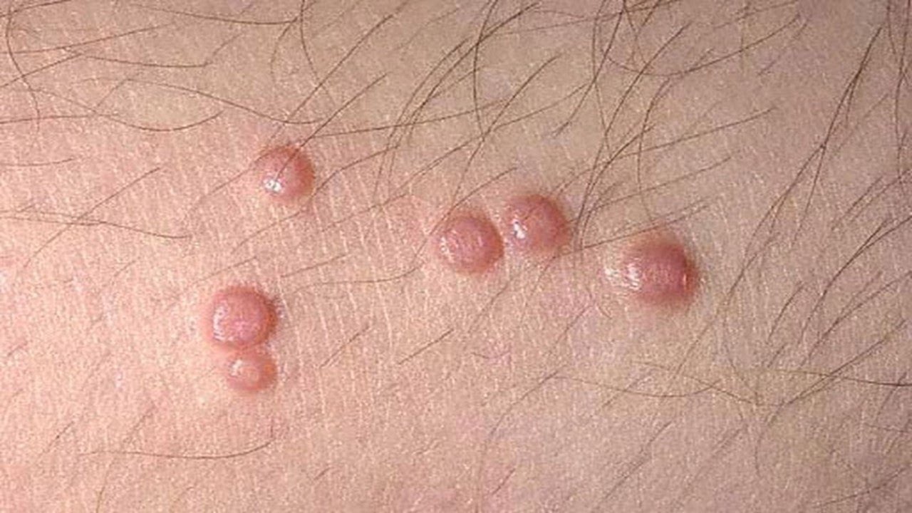 Verrugas Genitales En Hombres Vph En Hombres Causas
