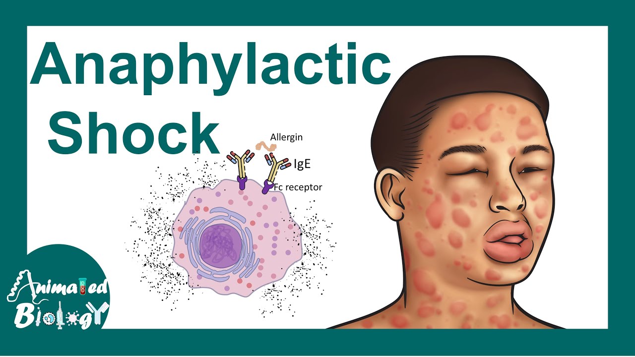Anaphylactic Shock Anaphylaxis Treatment Nursing 56 Off