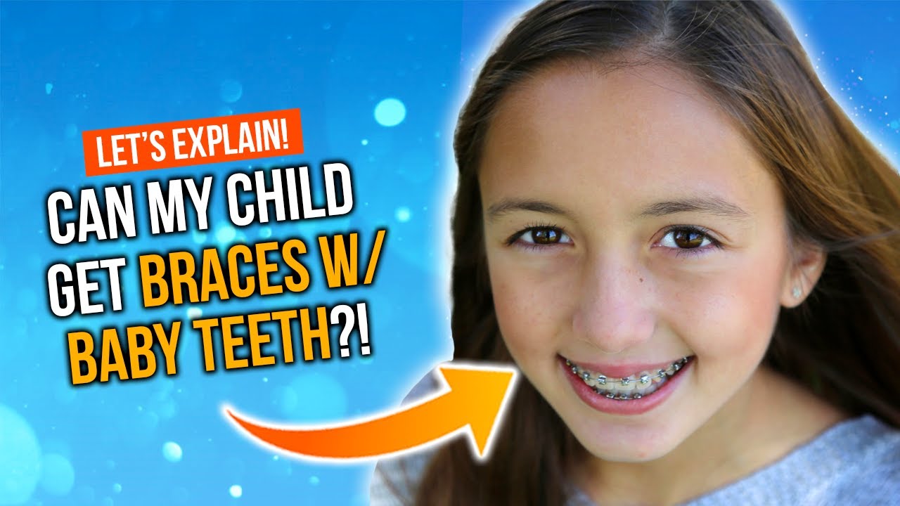 Braces For Baby Teeth At Robert Thaler Blog