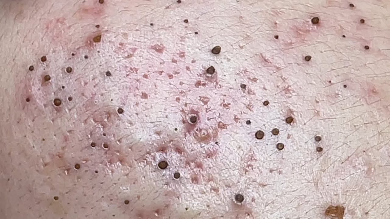 Relax With Massive Cystic Acne Popping Video