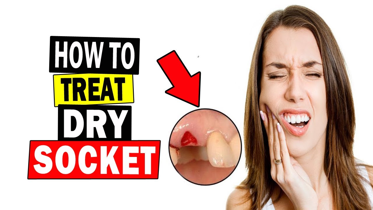 How To Treat Dry Socket With Clove Oil At Carl Cohn Blog