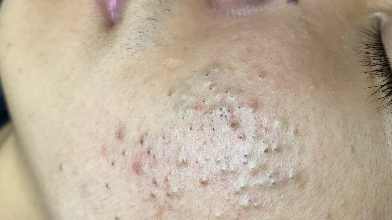 Make Your Acne Treatment Acne Spa 305 Sac Dep Spa Youtube