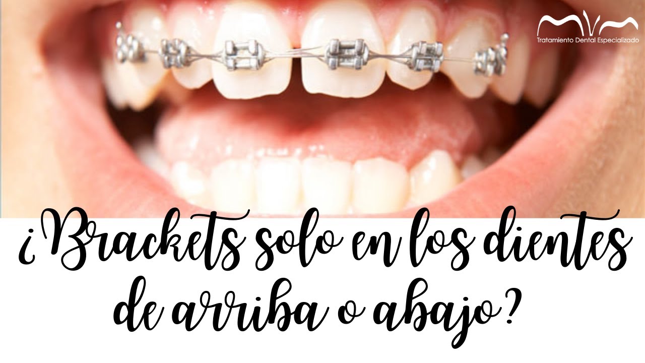 亞 Ortodoncia Con Pocos Brackets Es Posible 亞 Youtube