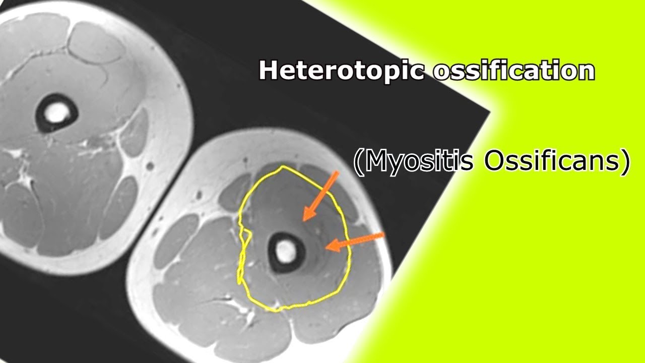 Heterotopic Ossification Myositis Ossificans Medical Documentary