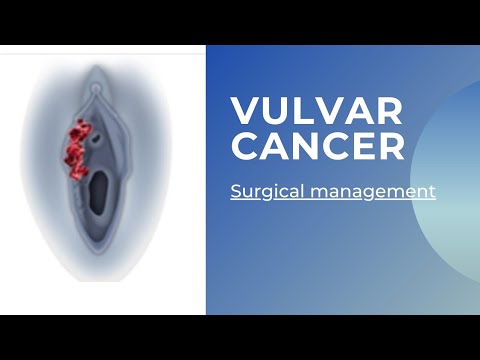 Vulvar Cancer Surgery Radical Vulvectomy Satasiahospital Youtube