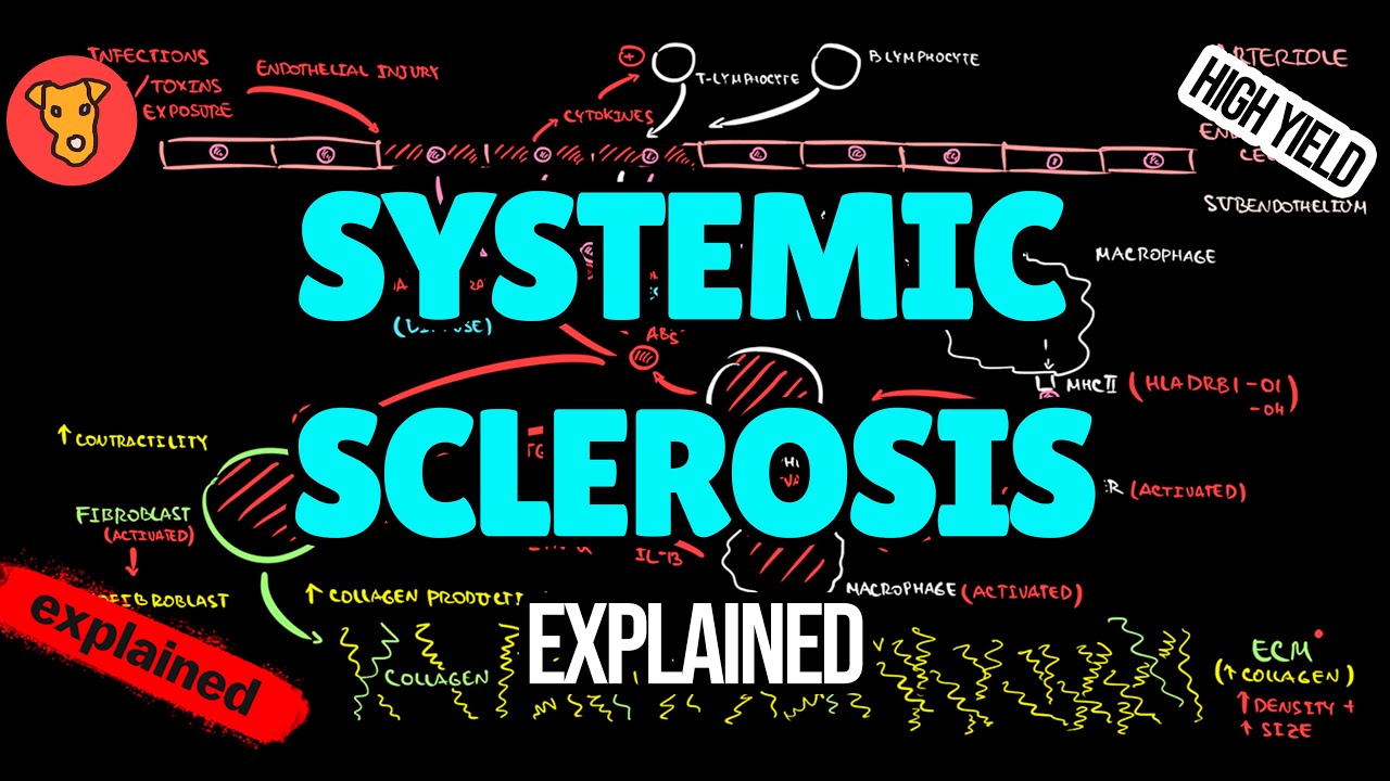 Scleroderma Systemic Sclerosis Explained Pathogenesis Diagnosis