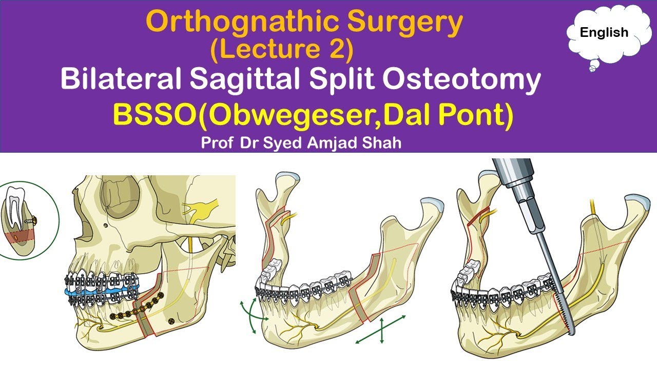 Osteotomy Dental Term At Amy Kates Blog