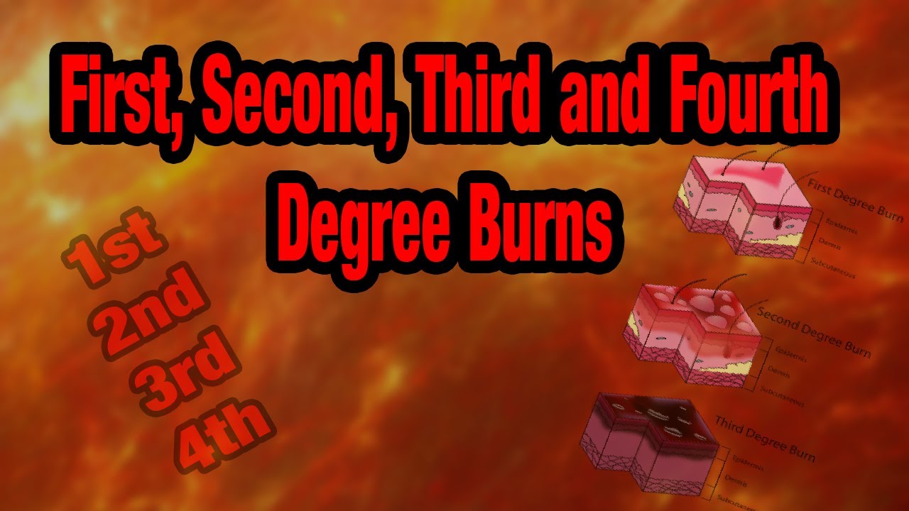 Difference Between First And Second Degree Burns Marpolf