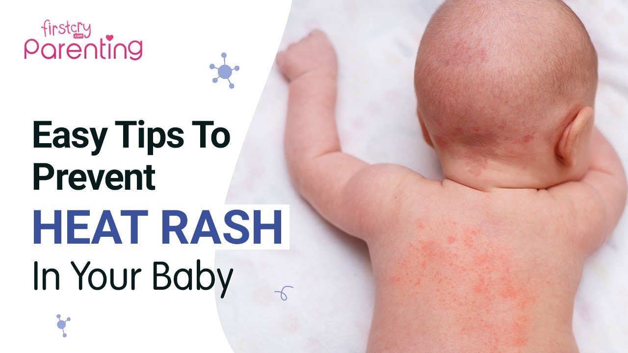 How To Treat And Prevent Heat Rash In Babies Youtube