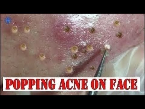 How To Removal Blackheads Whiteheads On The Face Easy Acne Treatment