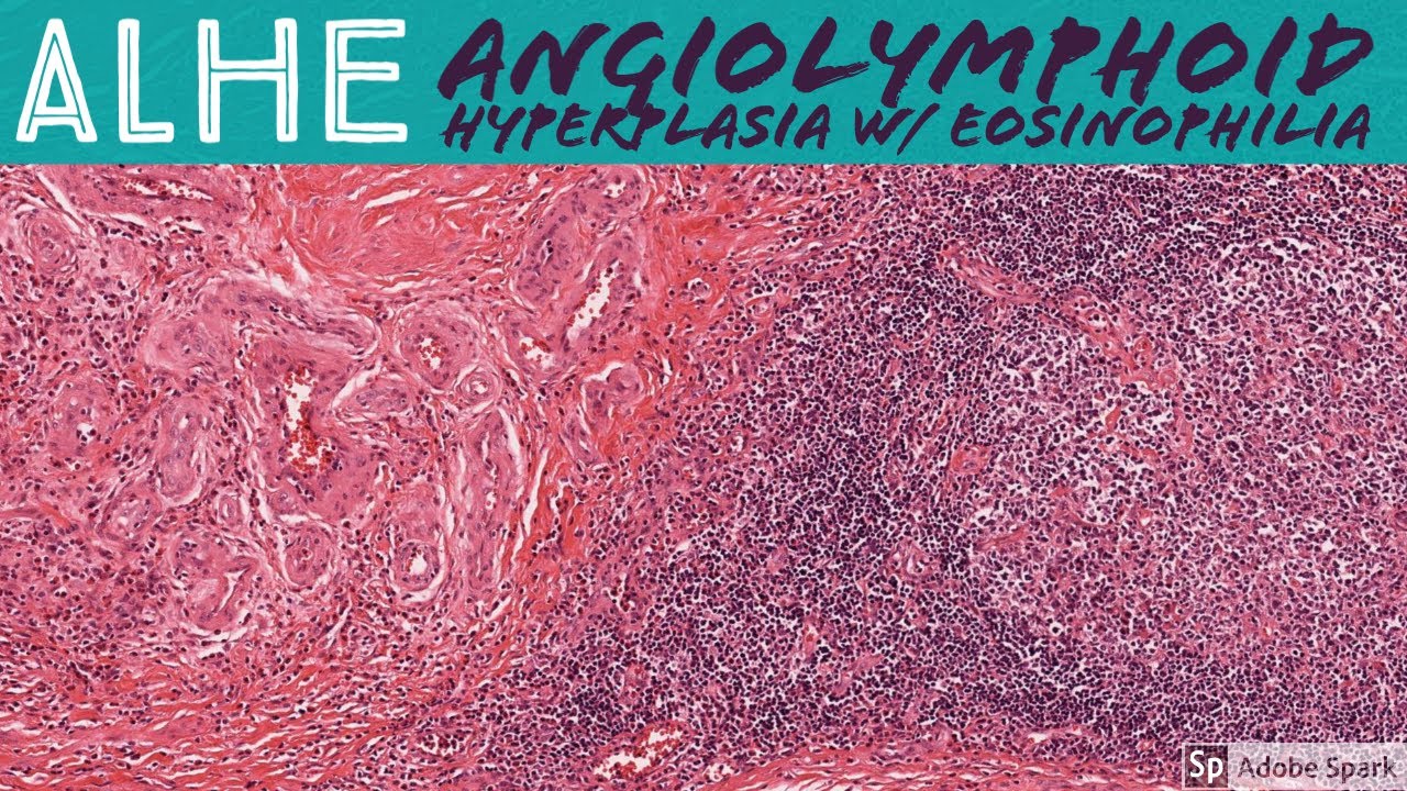 Alhe Angiolymphoid Hyperplasia With Eosinophilia 5 Minute Pathology