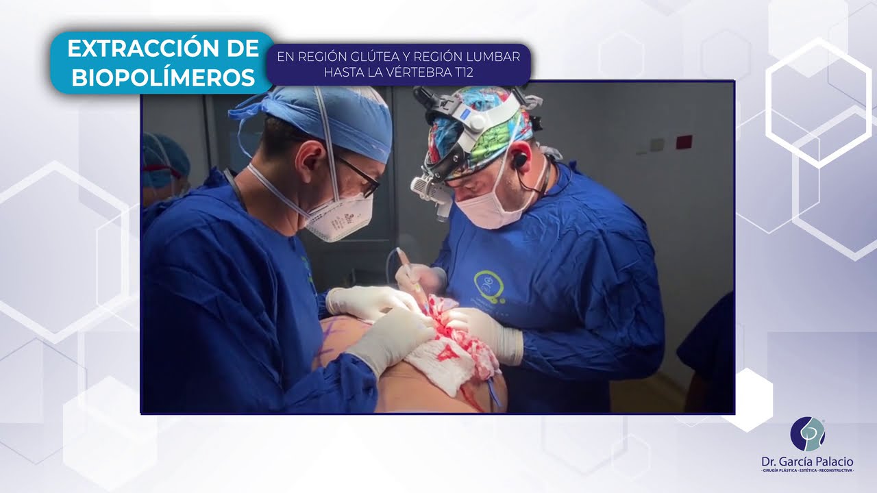 Extracción De Biopolímeros En Región Glútea Y Lumbar Youtube